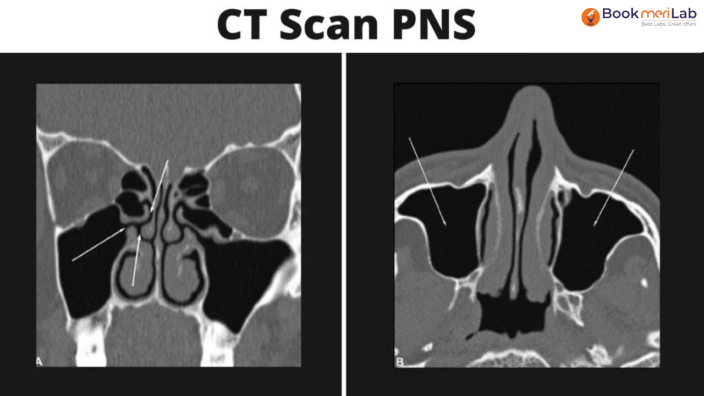 What Is Pns X Ray At Tom Wildes Blog
