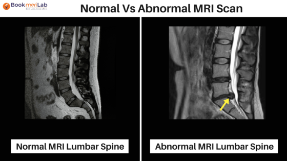 MRI LS Spine Price - Book Online at Top Radiology Centers