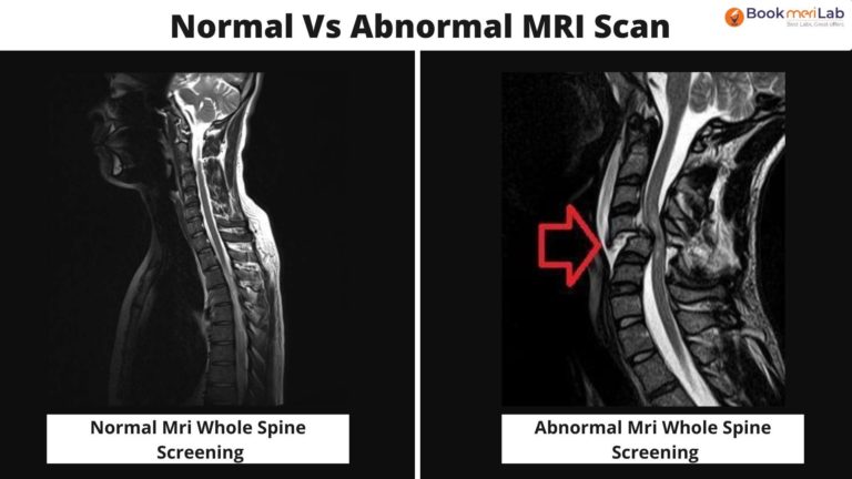 MRI Whole Spine Screening: Purpose, Results & Cost [2026]