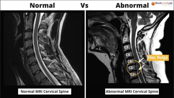 Abnormal Cervical Mri – Normal Vs Abnormal Cervical Spine Mri – TKKXDH