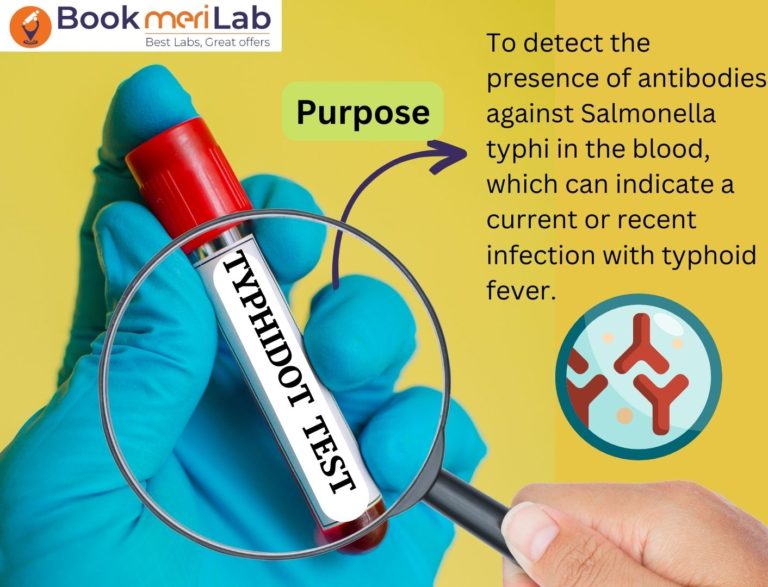Typhidot Test (IgM & IgG): Price, Purpose & Results [2026]